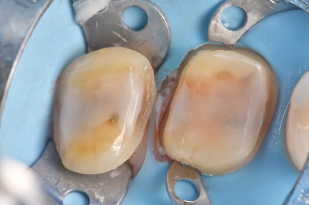 Indirect Overlay Provisional Restoration Solution