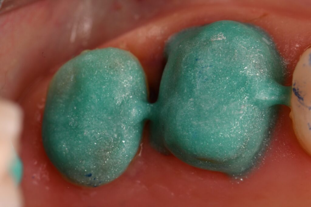 Indirect Overlay Provisional Restoration Solution