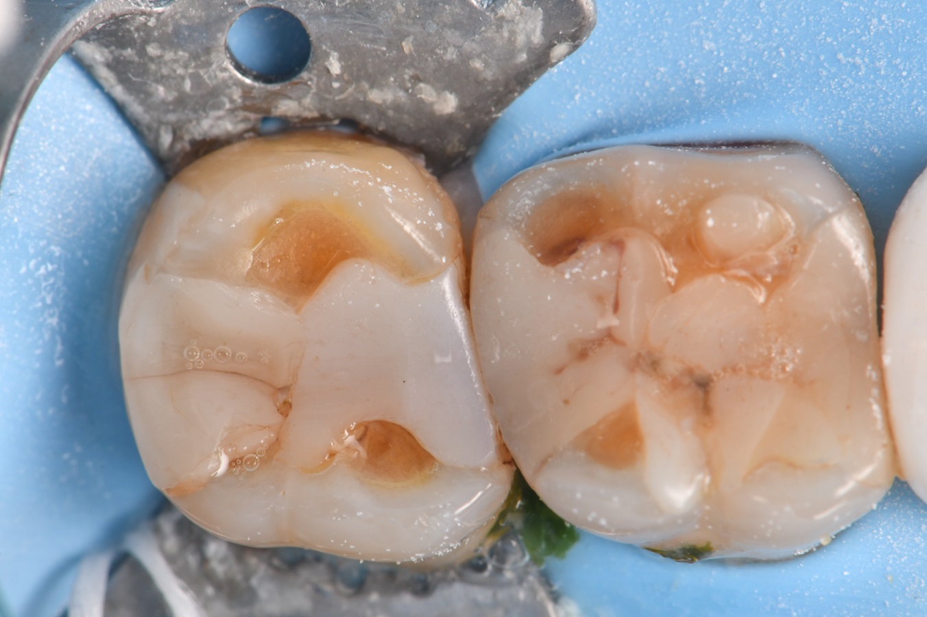 Emax preparation design for overlay in erosion case