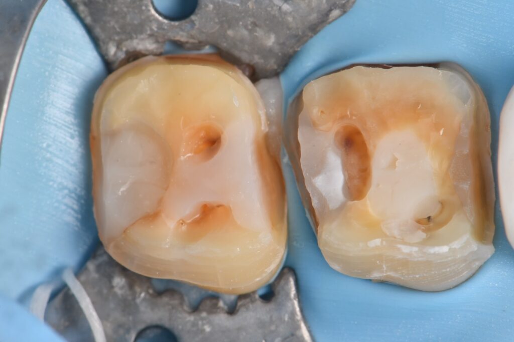 Emax preparation design for overlay in erosion case