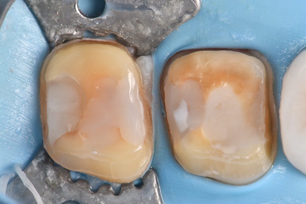 Emax preparation design for overlay in erosion case