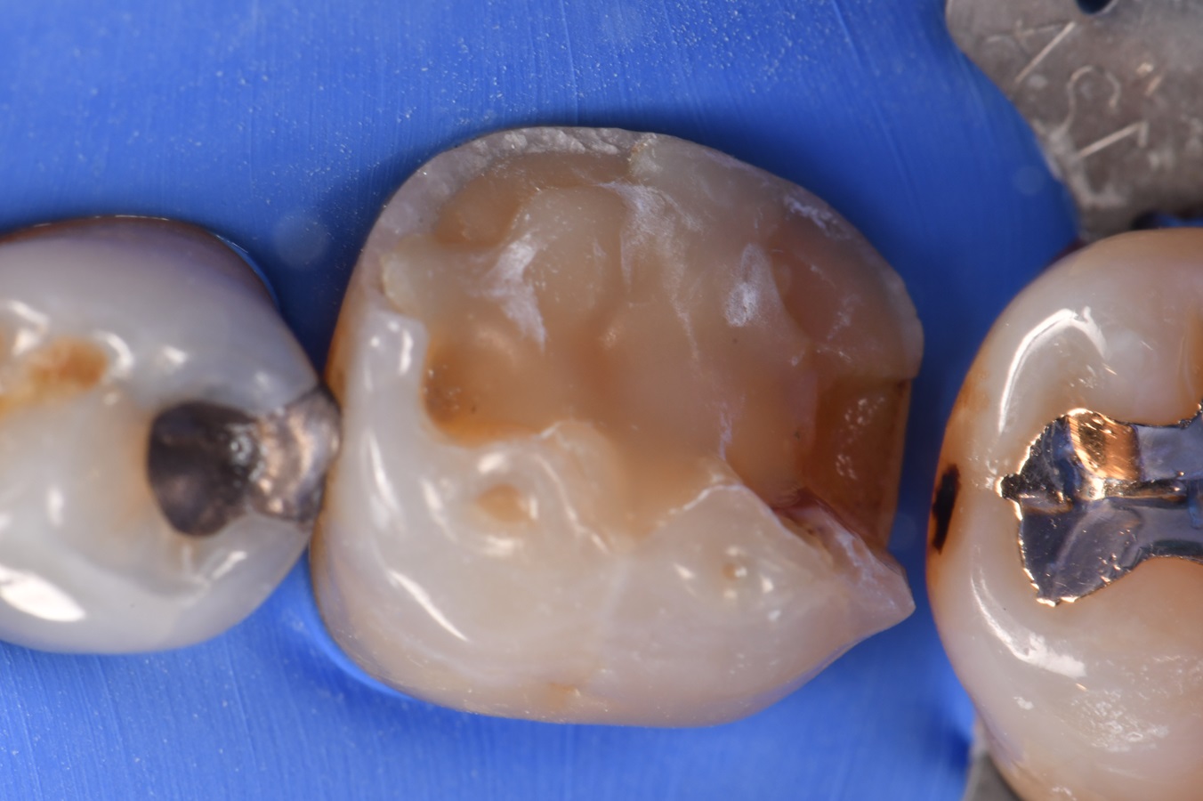 Novel technique for Minimally Invasive Gold Onlay Placement