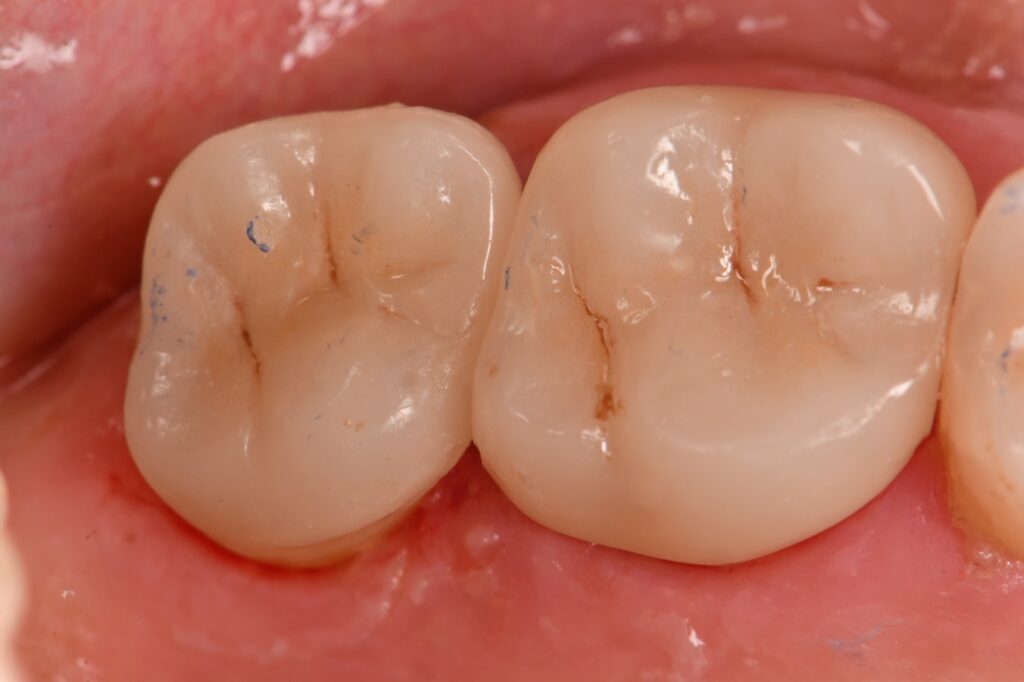 Indirect Overlay Provisional Restoration Solution