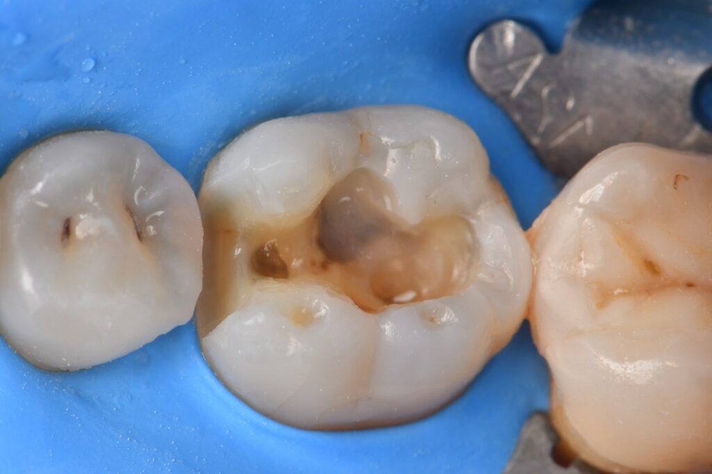 Lower First Molar Anatomy Variation with Grandio SO