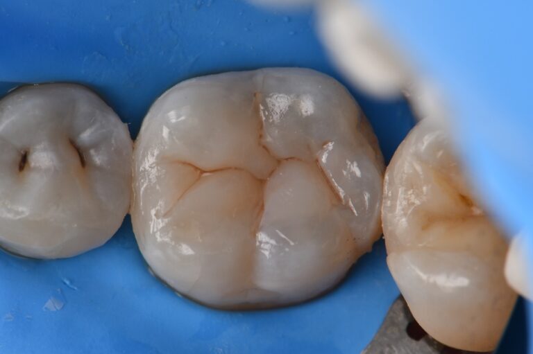 Lower First Molar Anatomy Variation with Grandio SO