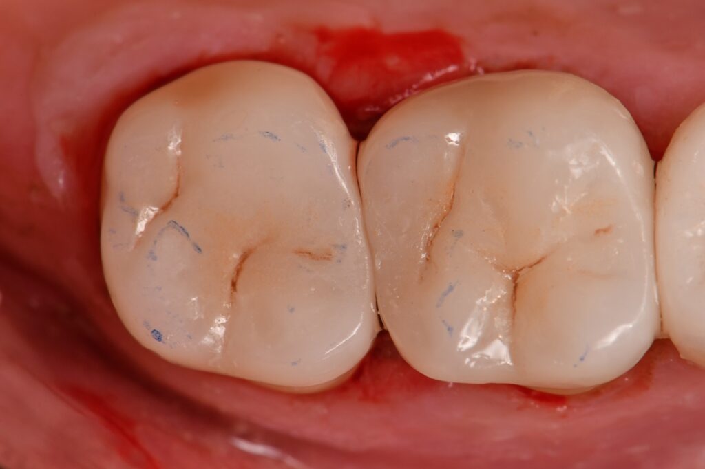 Emax preparation design for overlay in erosion case