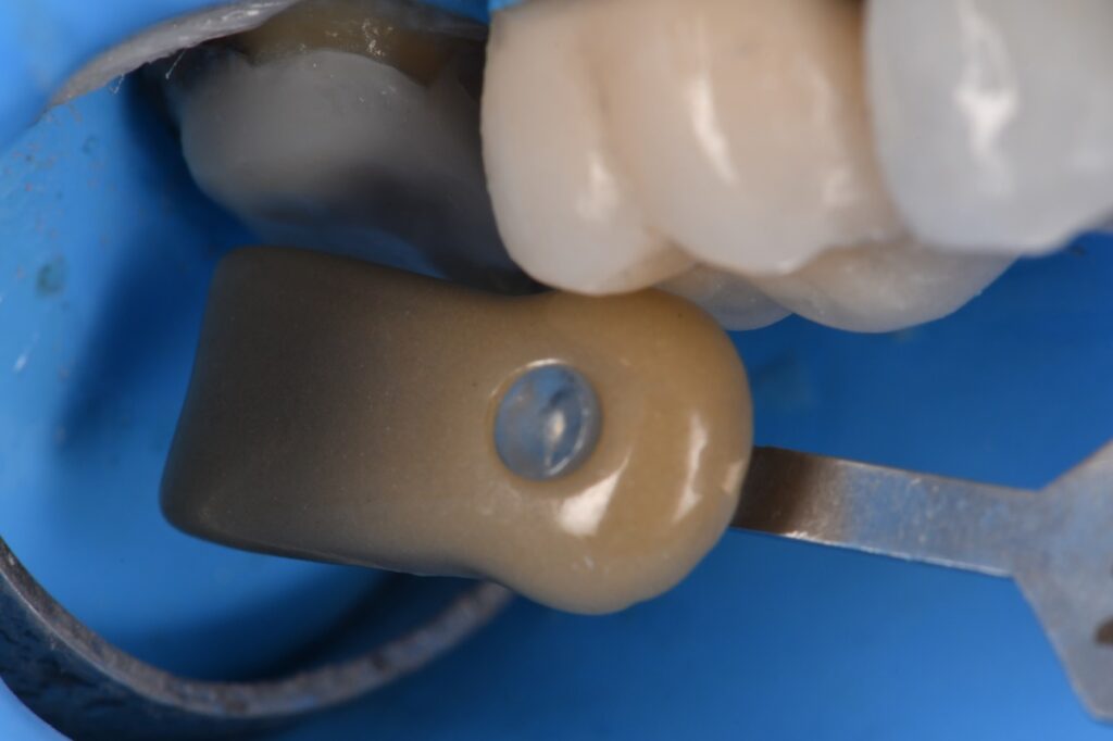 Provisional Solution for Overlay and Full Workflow with IPS e-max