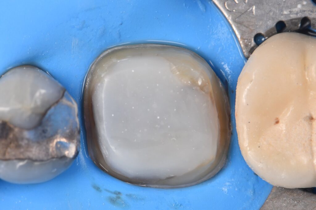 Indirect Dental Crown Workflow under Isolation