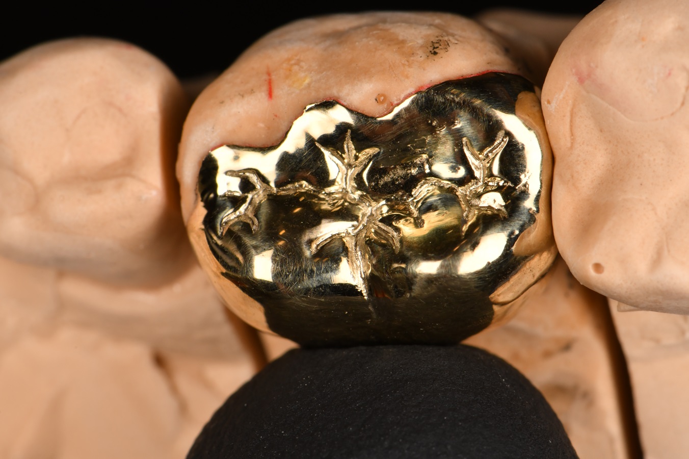 Novel technique for Minimally Invasive Gold Onlay Placement