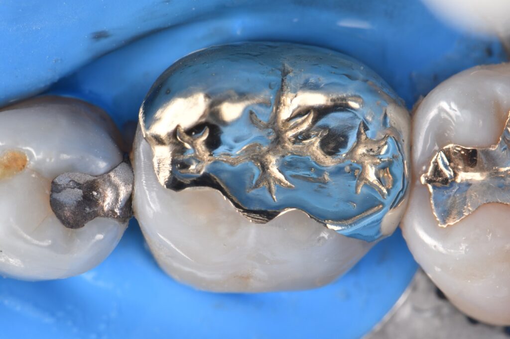 Novel technique for Minimally Invasive Gold Onlay Placement