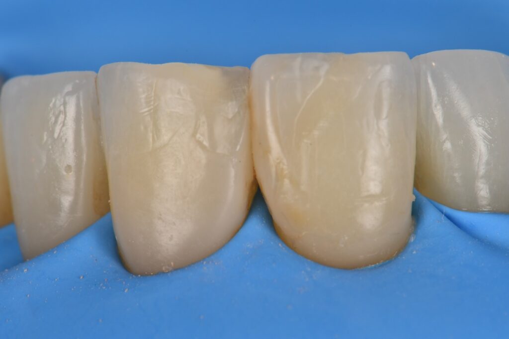 Additive composite dentistry