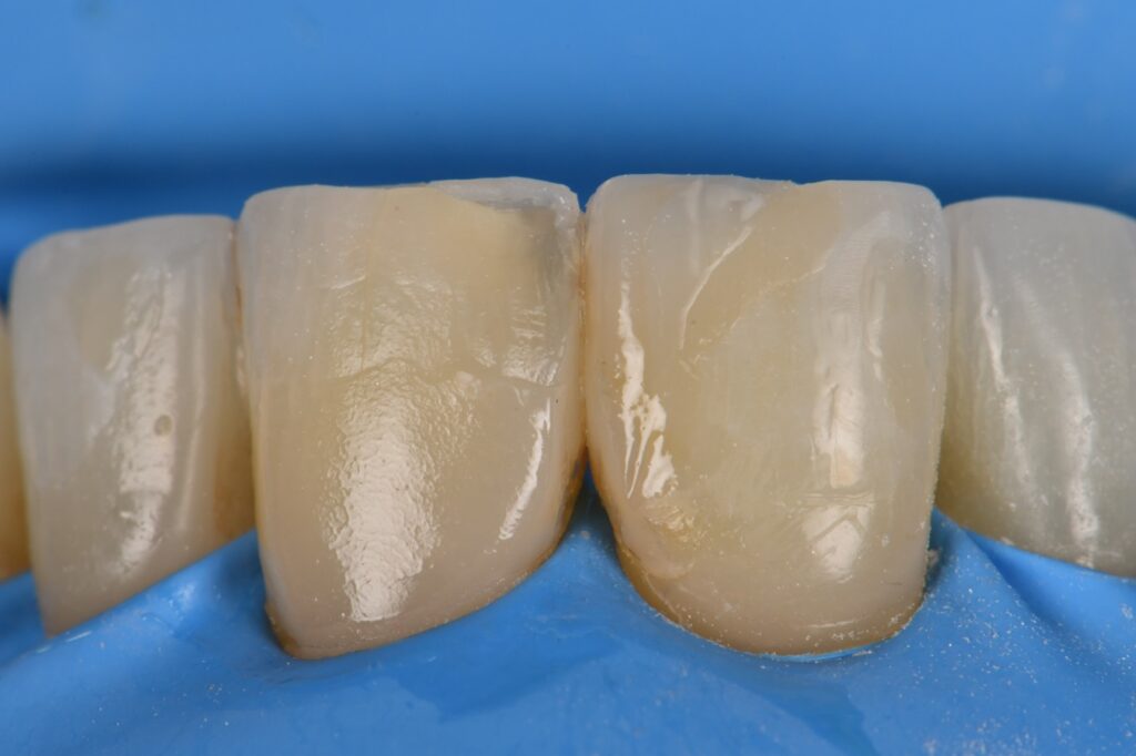 Additive composite dentistry