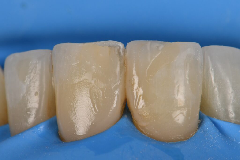 Additive composite dentistry
