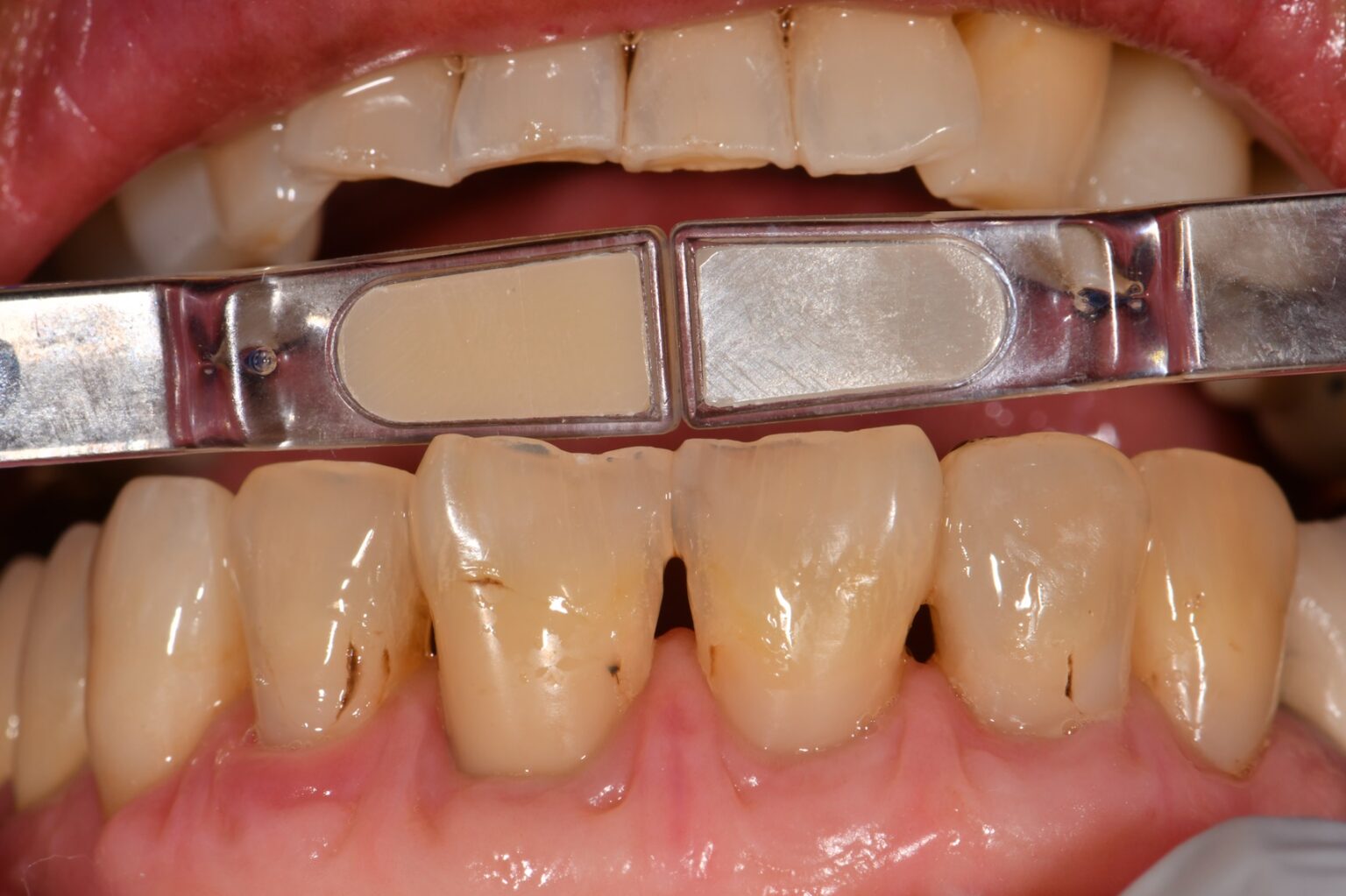 Restorative Derotation of Teeth and closure of black triangles