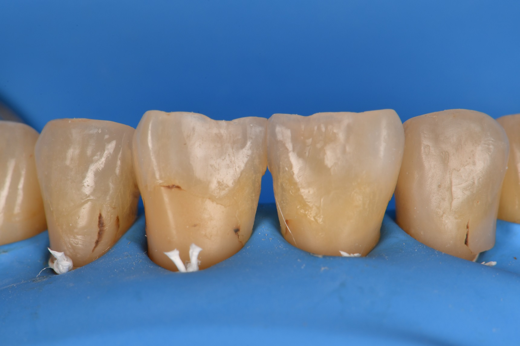 Restorative Derotation of Teeth and closure of black triangles