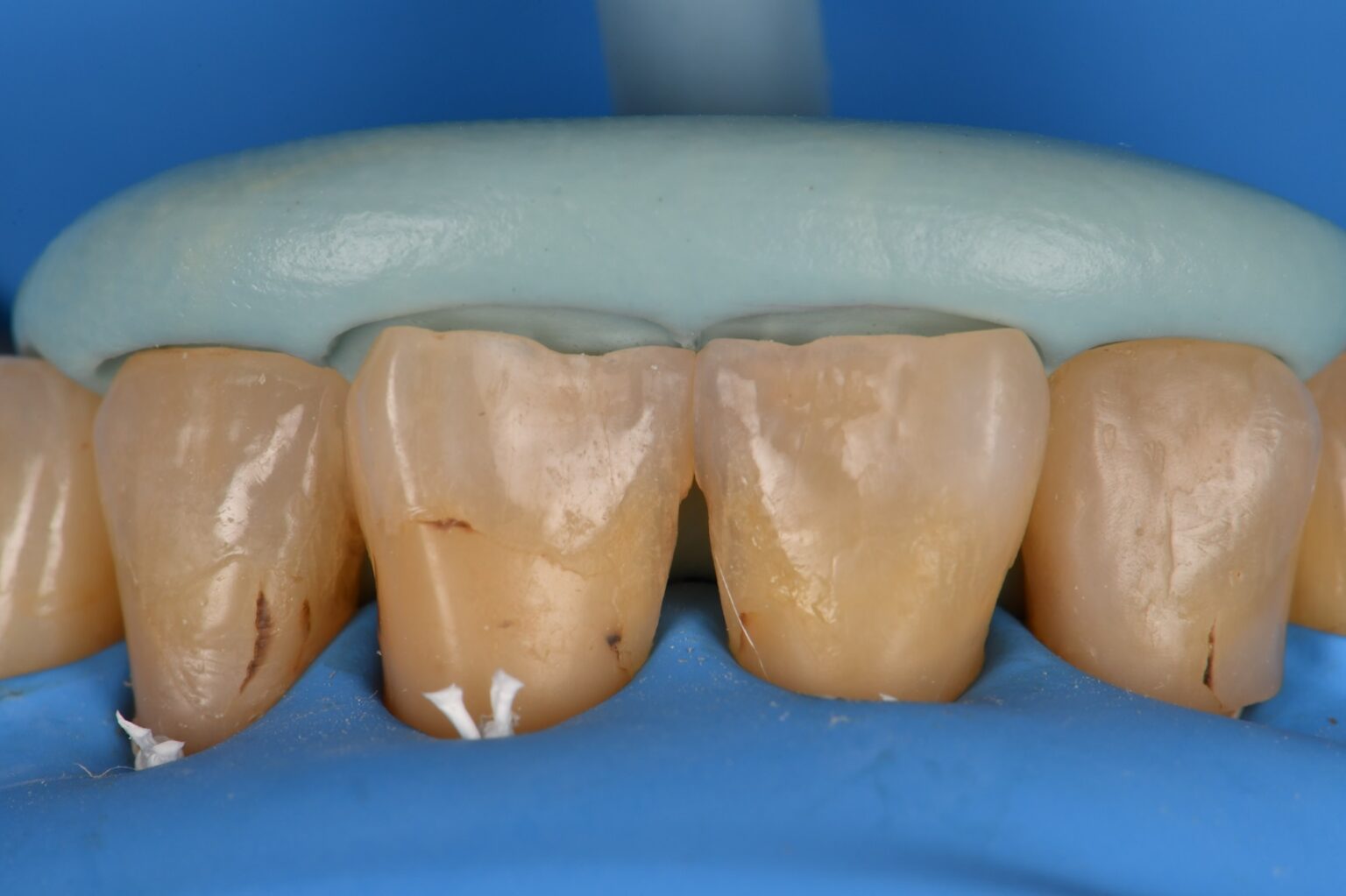 Restorative Derotation of Teeth and closure of black triangles