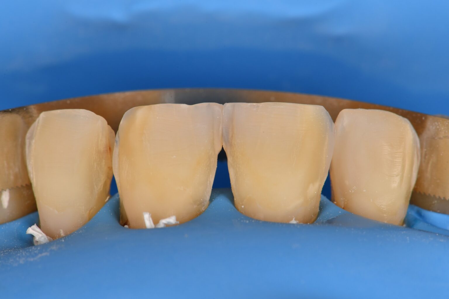 Restorative Derotation of Teeth and closure of black triangles