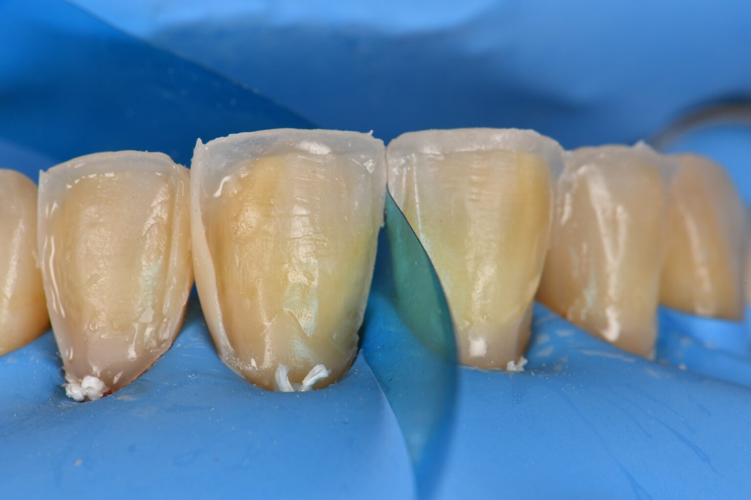 Restorative Derotation of Teeth and closure of black triangles