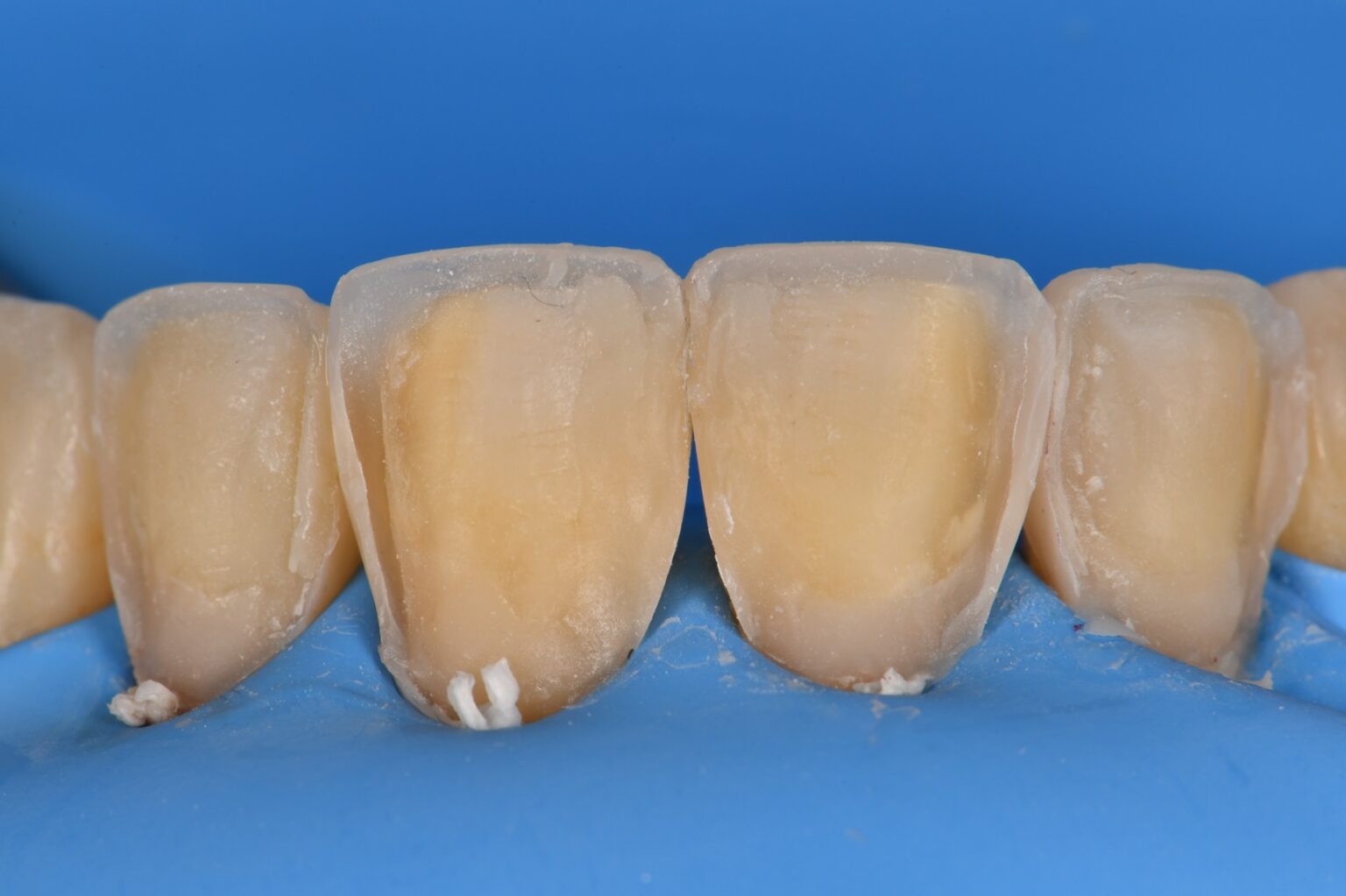 Restorative Derotation of Teeth and closure of black triangles