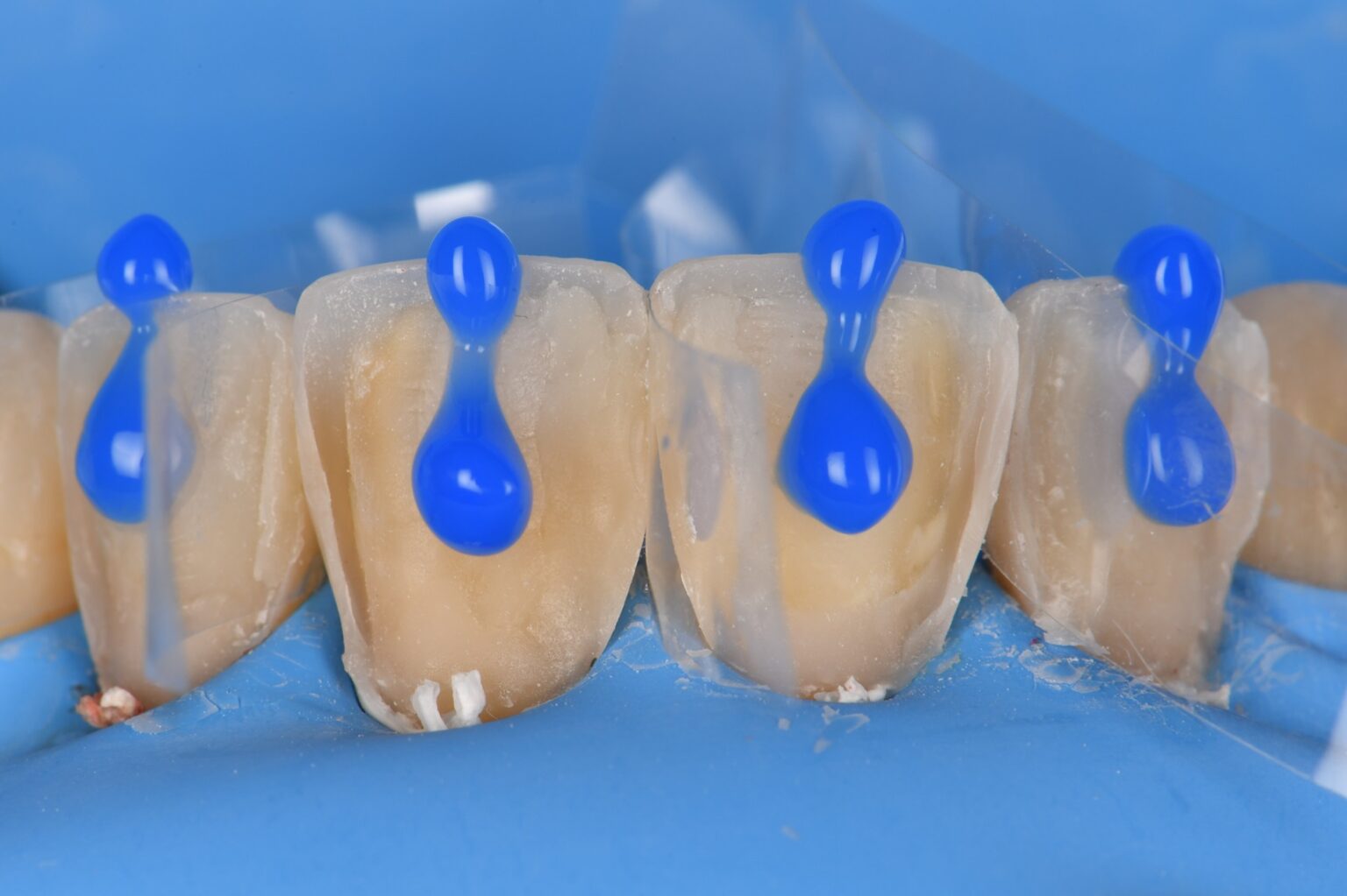 Restorative Derotation of Teeth and closure of black triangles