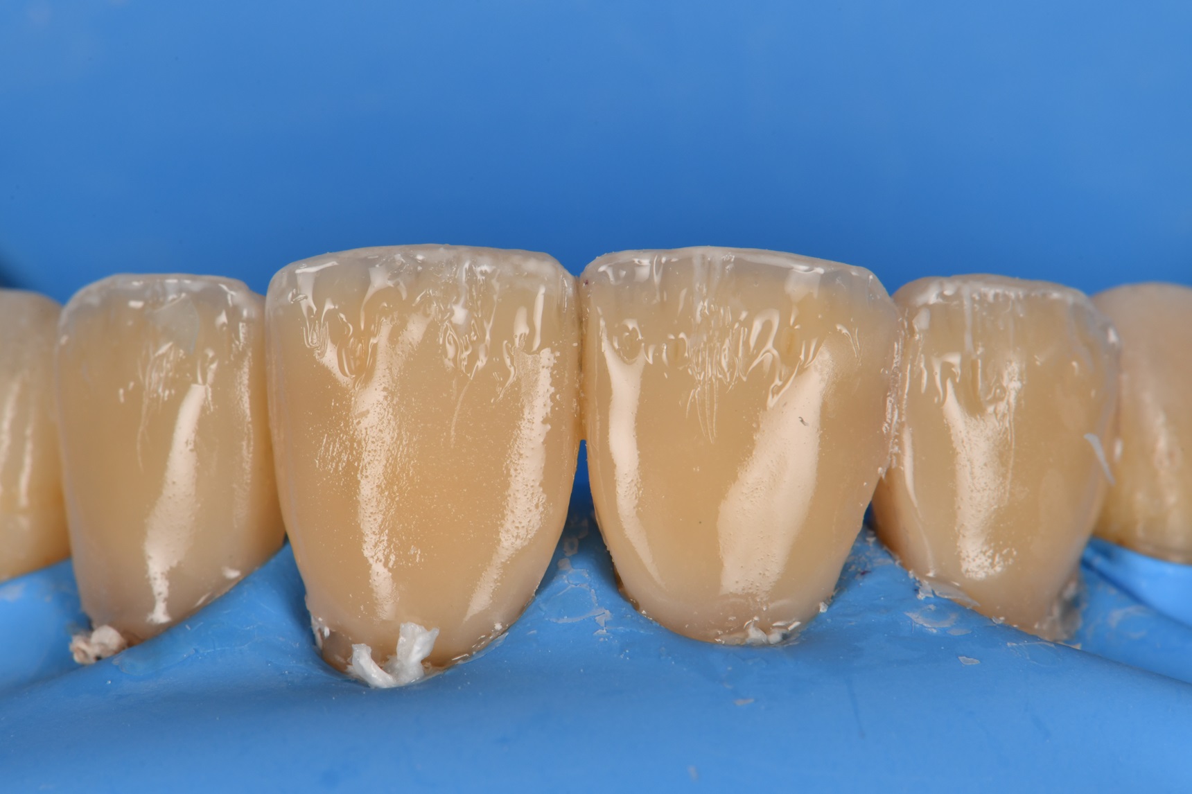 Restorative Derotation of Teeth and closure of black triangles