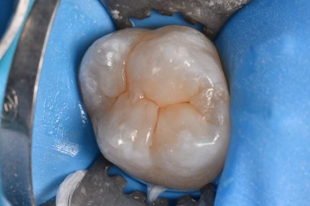 Supercomposite used in a Class I restoration replacement