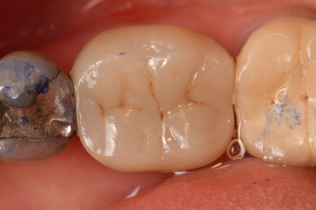 Indirect Dental Crown Workflow under Isolation