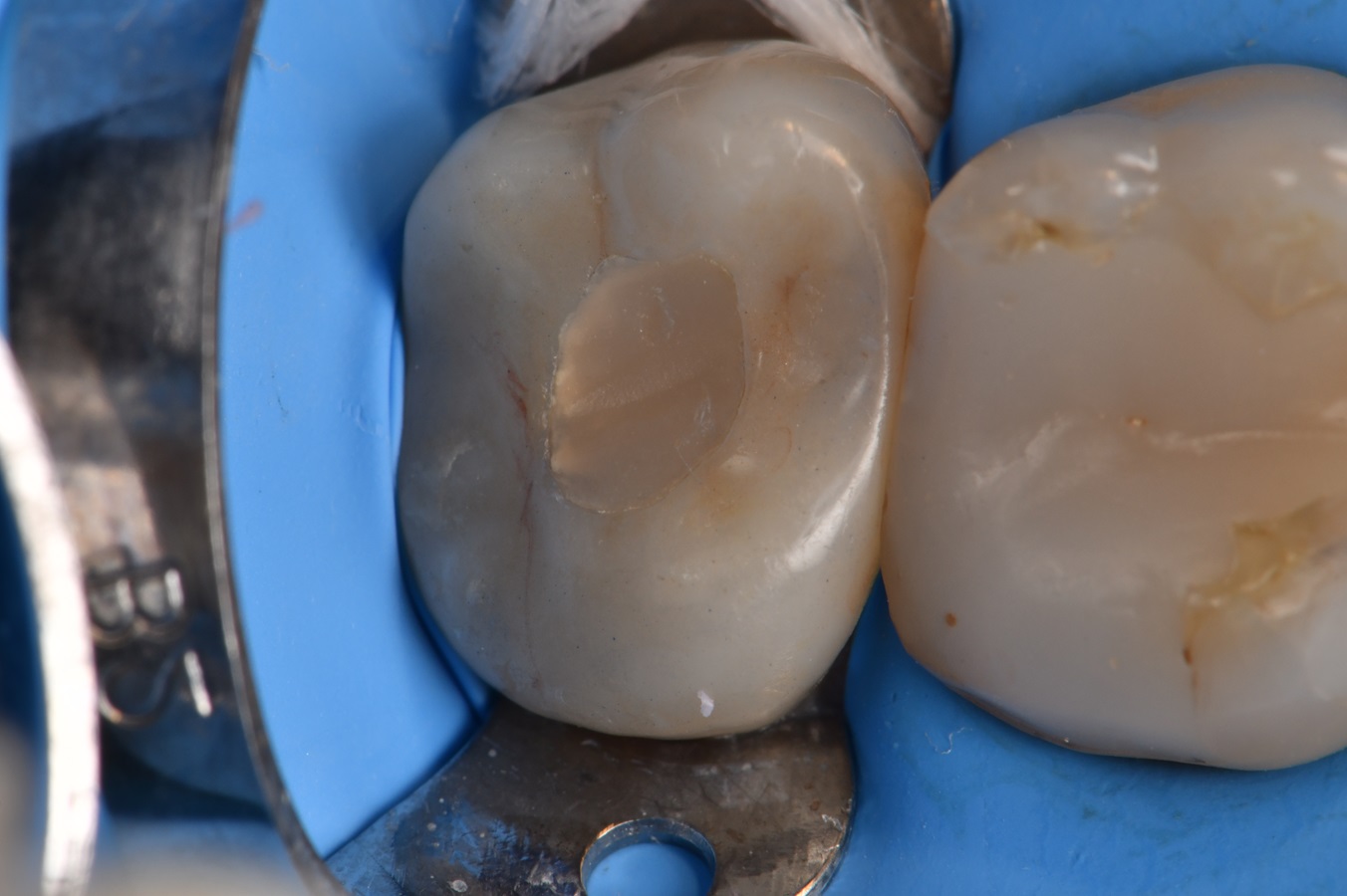 Endocore and Crown Replacement Workflow