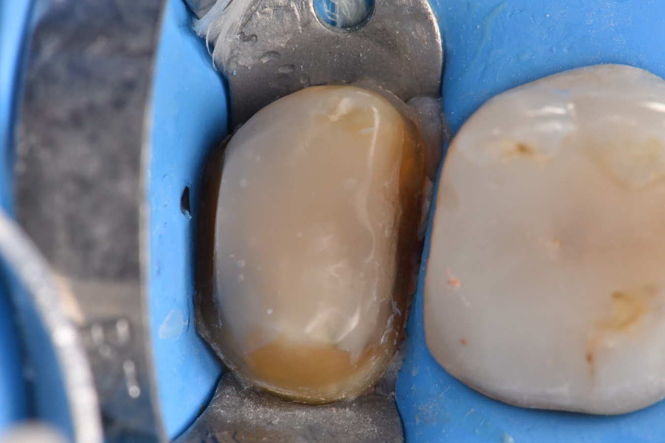 Endocore and Crown Replacement Workflow