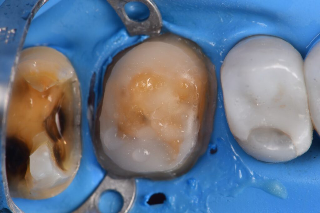 The Braced Thimble Technique in Indirect Dentistry