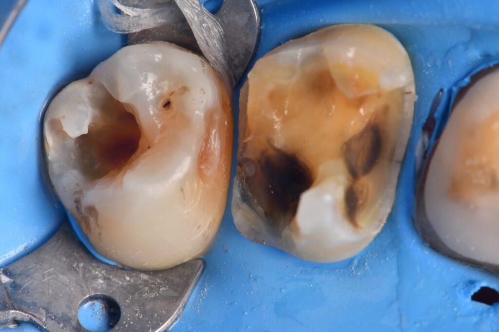 The Braced Thimble Technique in Indirect Dentistry