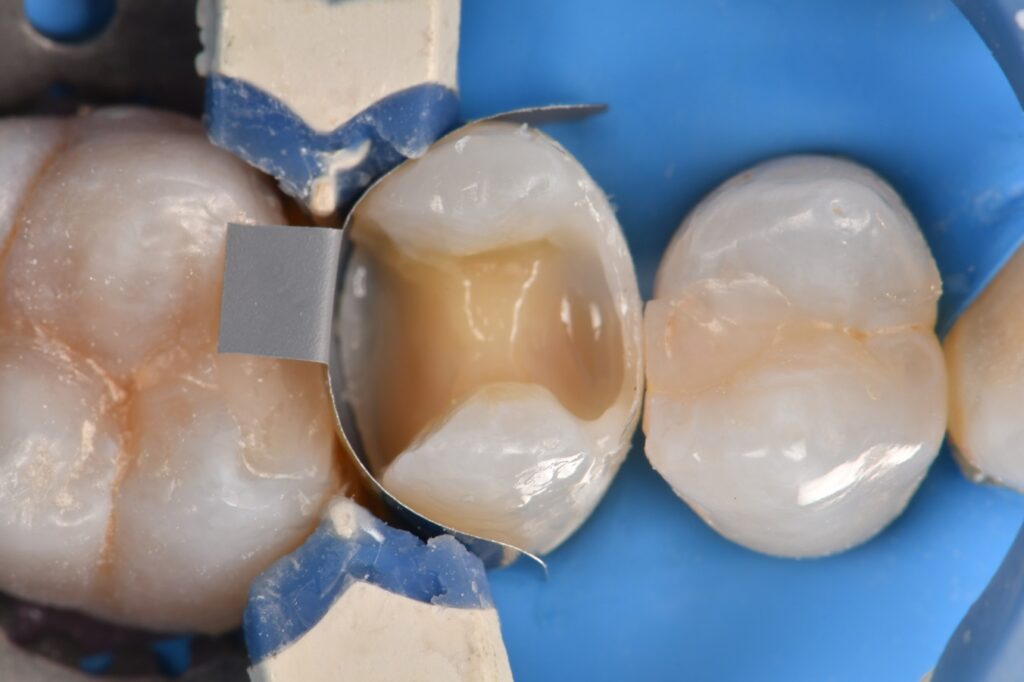 Direct Composite MOD with Kerr Simplishade and Garrison