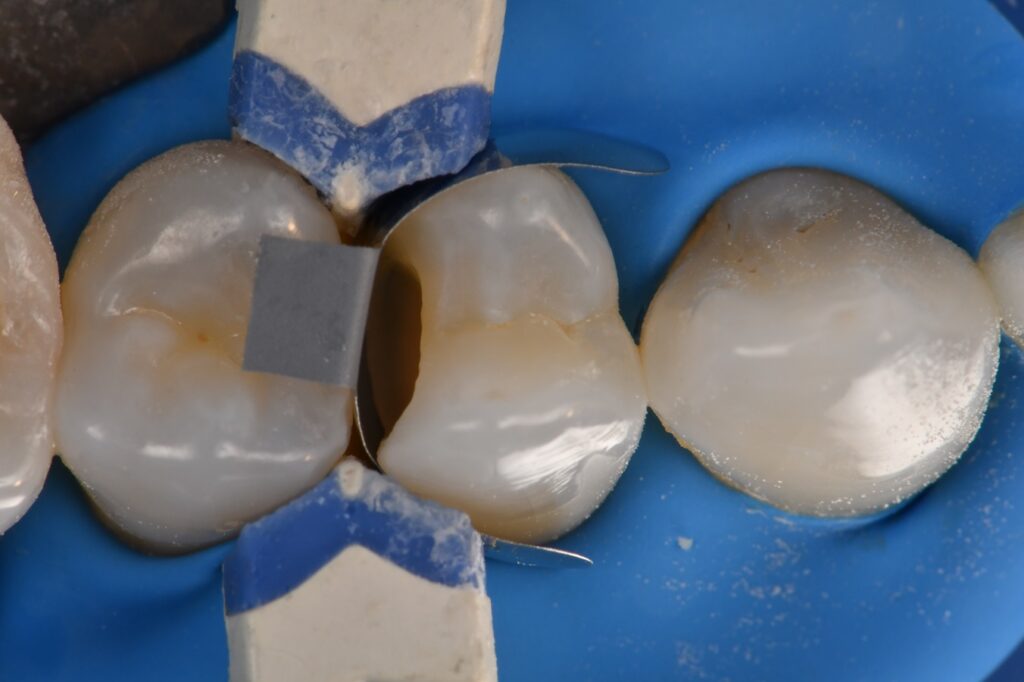 Slot Precision Restorations with Voco