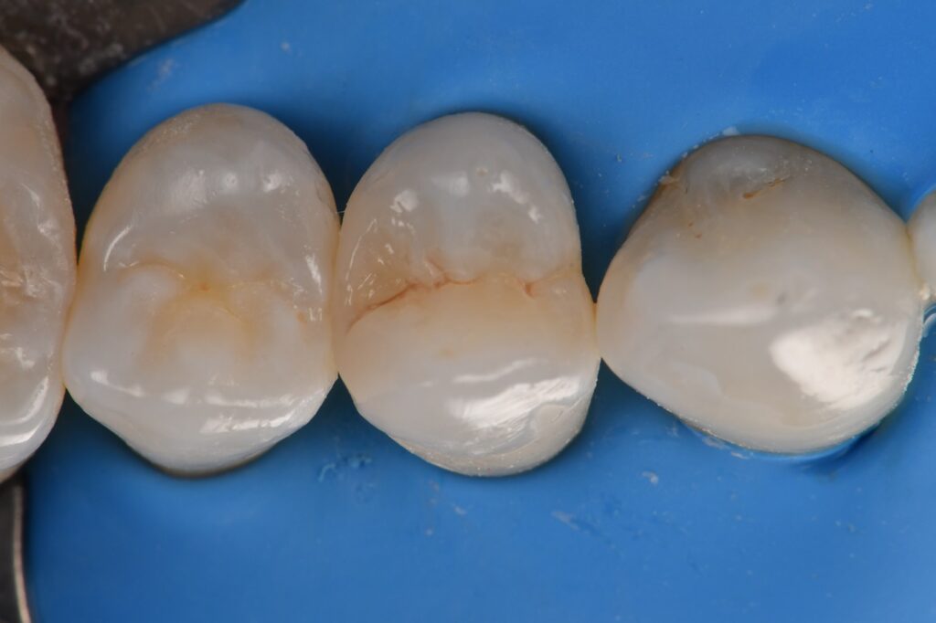 Slot Precision Restorations with Voco