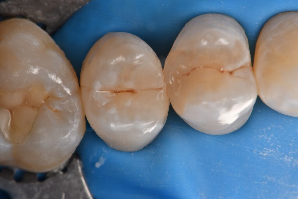 Class II direct solution using Grandio SO and Garrison