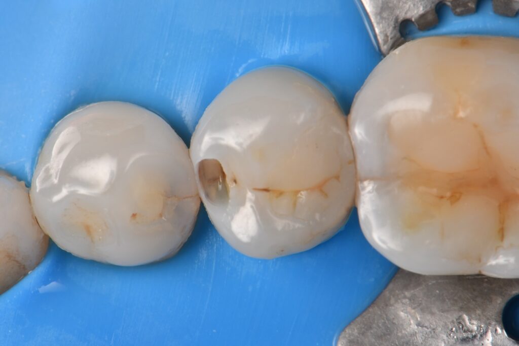 Class II slot restoration progression pictures