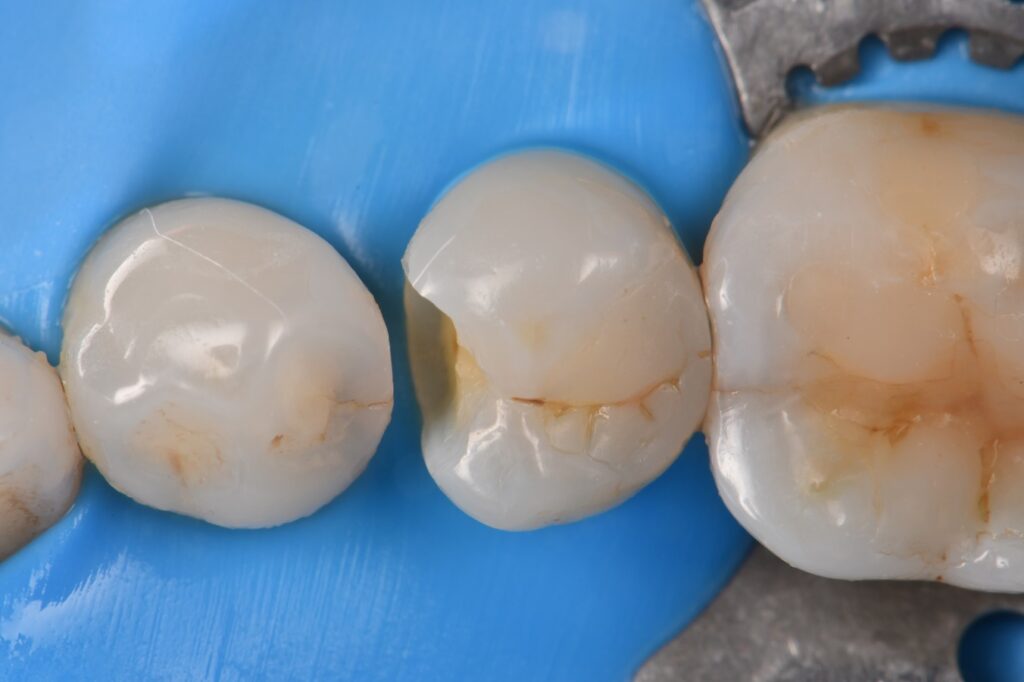 Class II slot restoration progression pictures