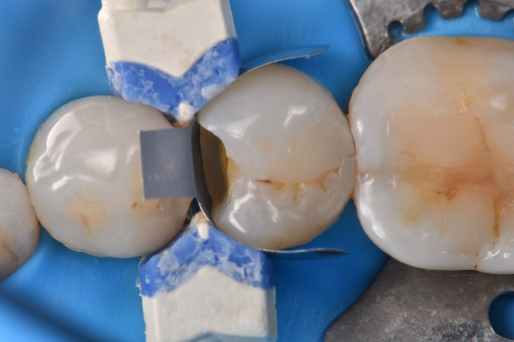 Class II slot restoration progression pictures