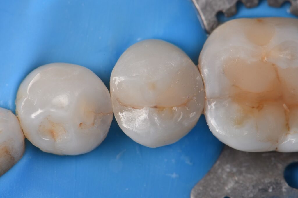 Class II slot restoration progression pictures