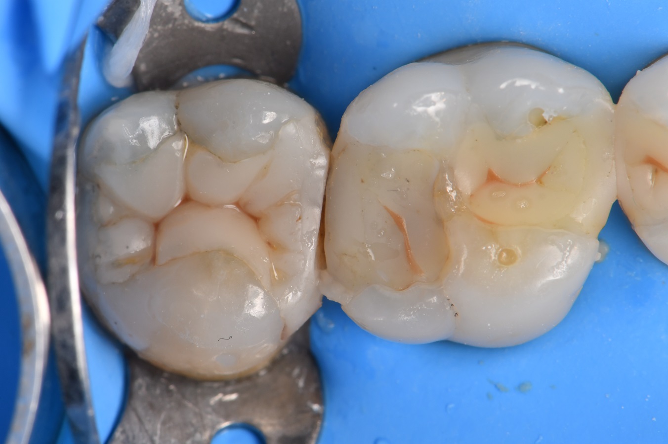 Addressing recurrent caries on the root with new composite