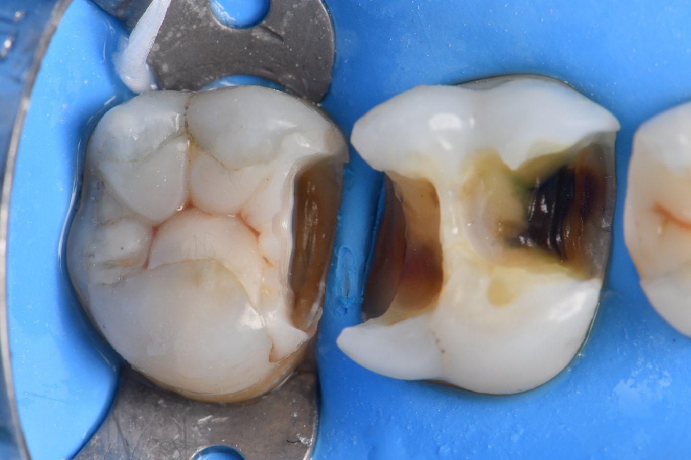 Addressing recurrent caries on the root with new composite
