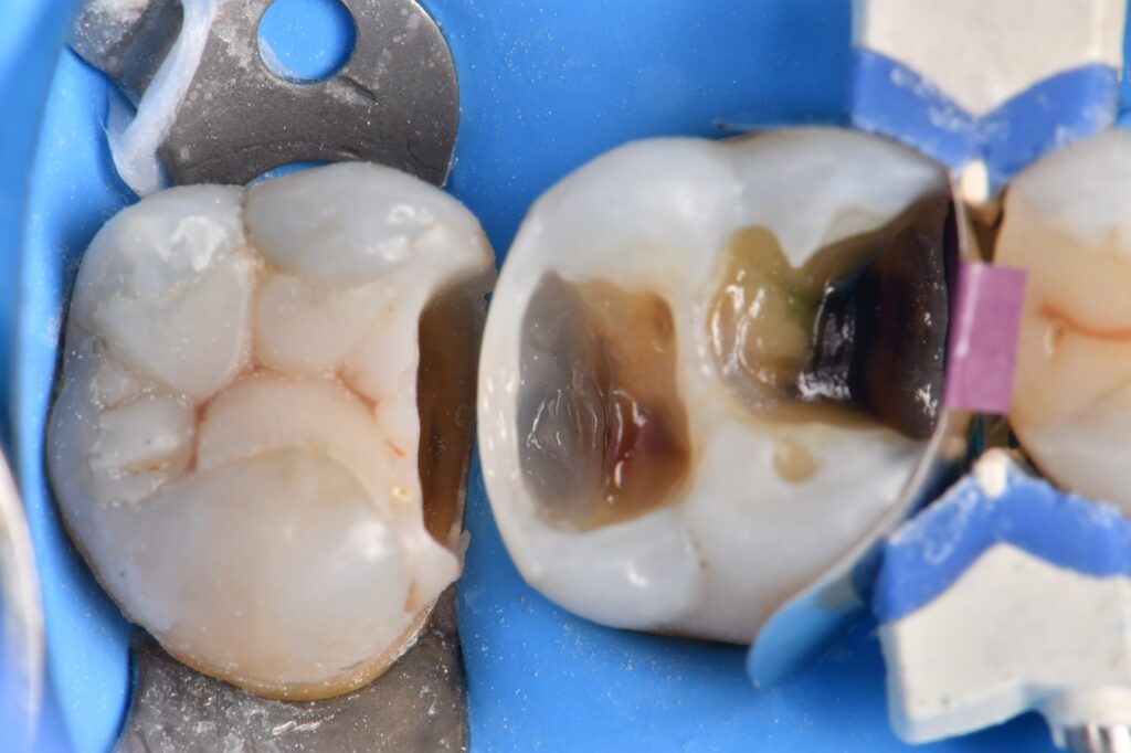 Addressing recurrent caries on the root with new composite