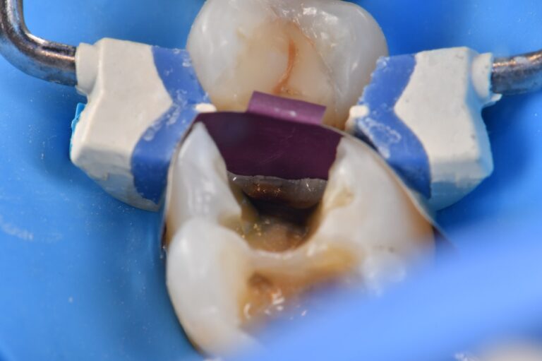 Addressing recurrent caries on the root with new composite
