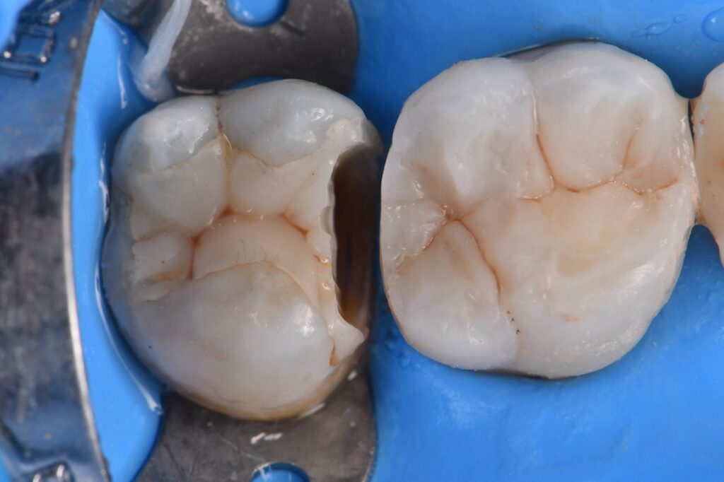 Addressing recurrent caries on the root with new composite