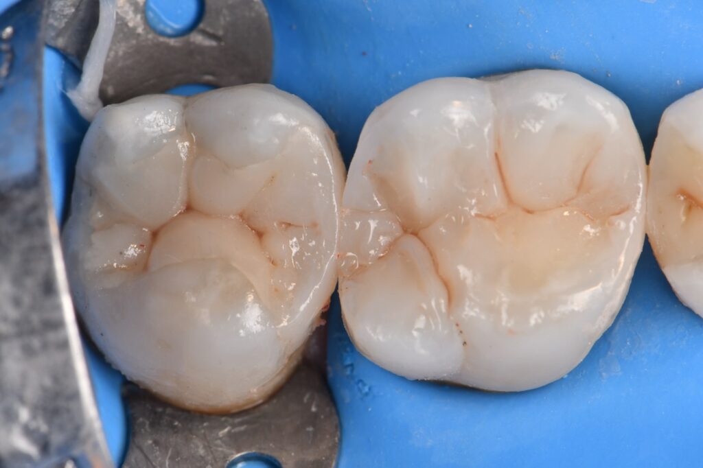 Addressing recurrent caries on the root with new composite