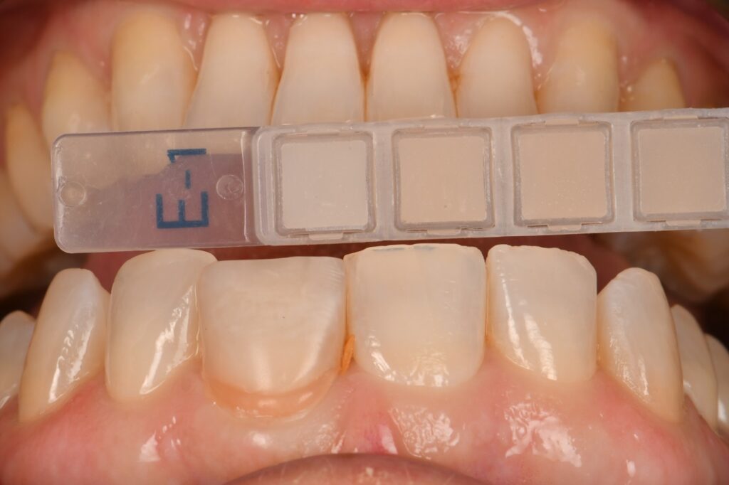 How to use Voco Amaris Gingiva and Layered Composite