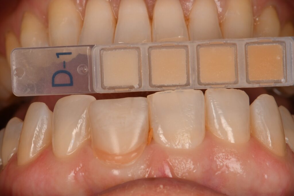 How to use Voco Amaris Gingiva and Layered Composite