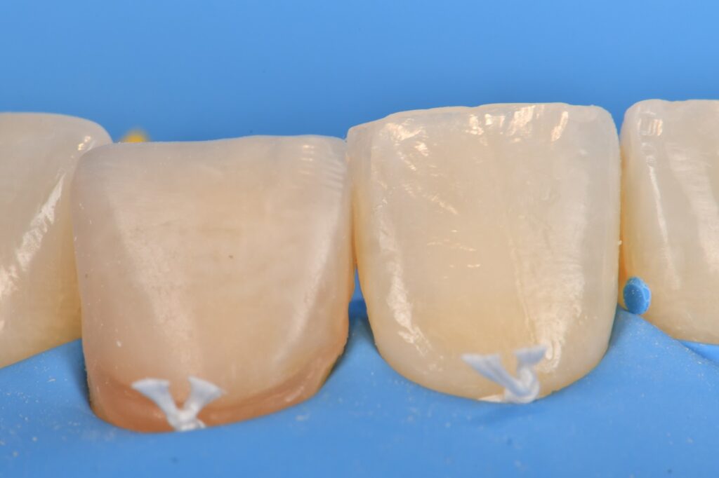 How to use Voco Amaris Gingiva and Layered Composite