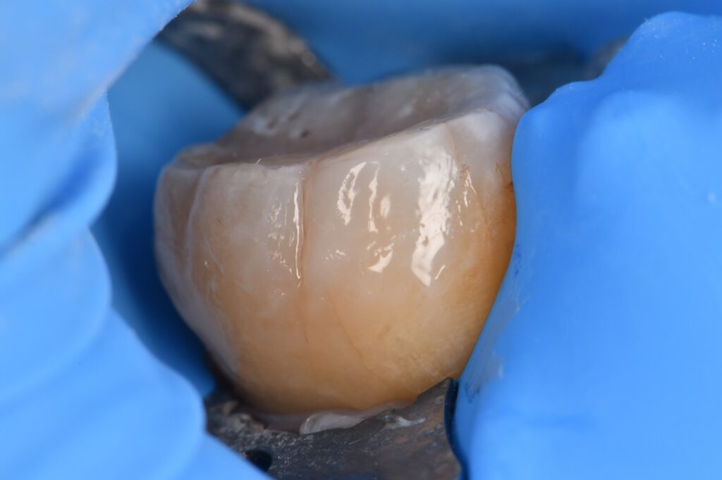 Fine Fissure Detail with Voco Grandio SO