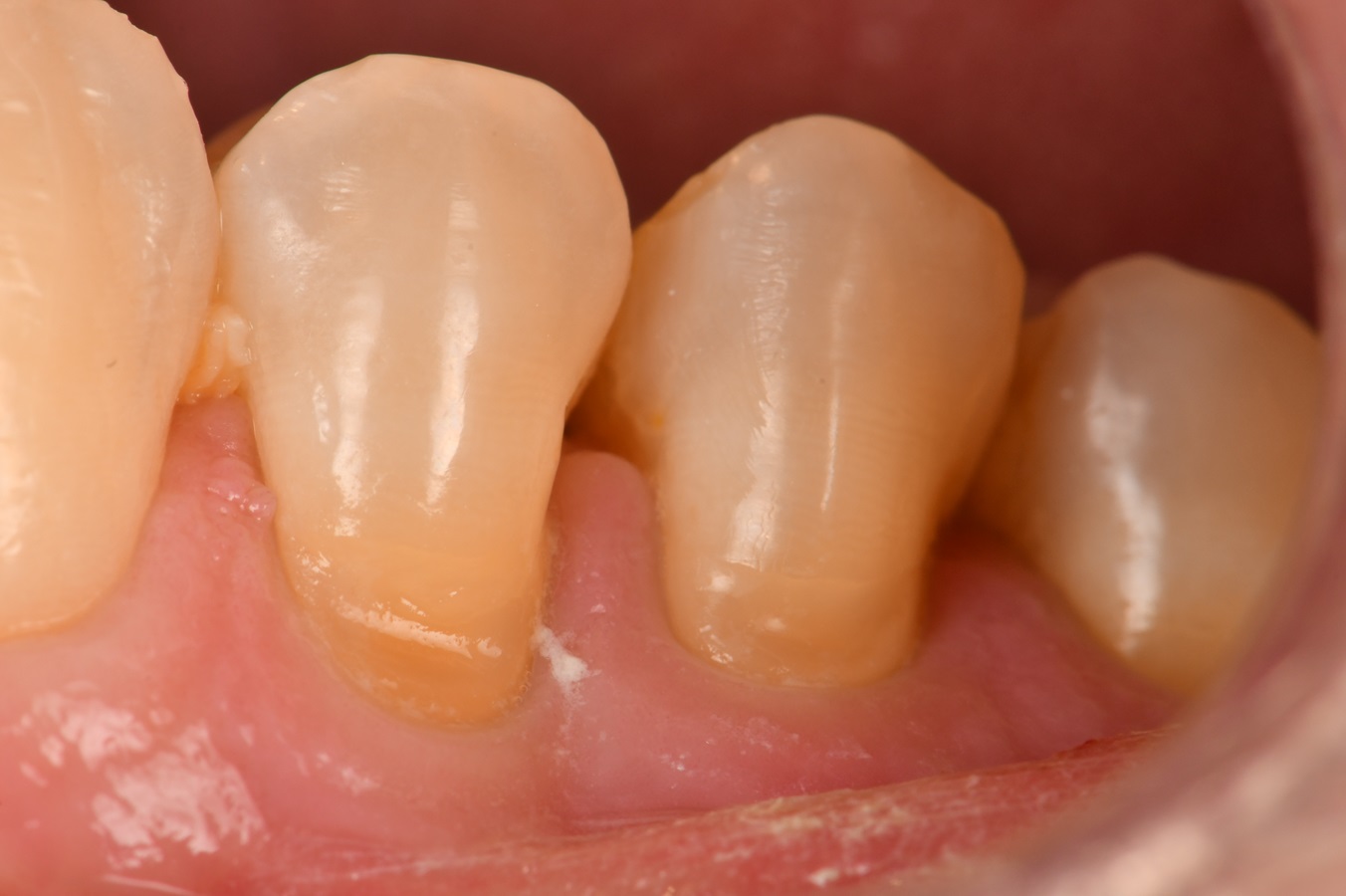 Average Value Composites for Class 5 restorations